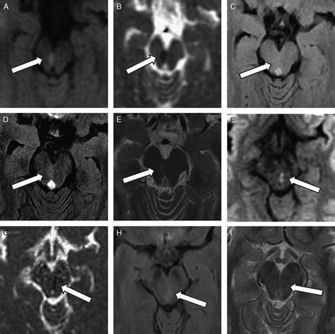 Isolated Midbrain Ischemic Infarct In Association With Hyper