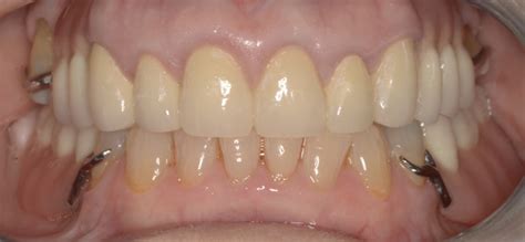 Combined Prosthetic Rehabilitation Fixed and Removable Clínica