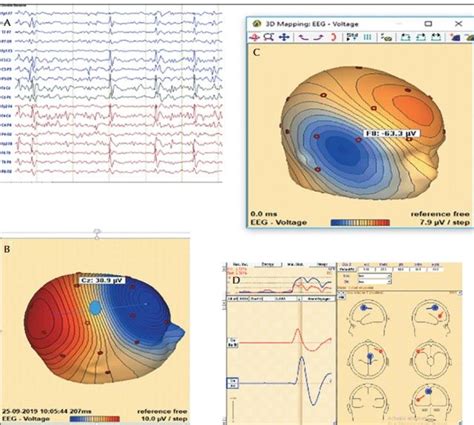 Balaram Et Al Describe Eeg Patterns In Electrical Status Epilepticus