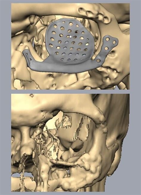 Maxillofacial Lucid Implants Psis For Cmf And Ortho