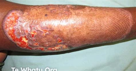 Pyoderma Gangrenosum Image