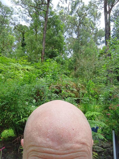 Anyone With A Shaved Head And Severe Scalp Hyperhidrosis R Hyperhidrosis