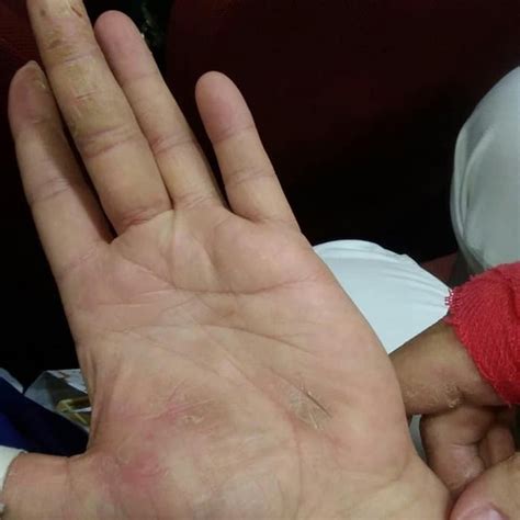 Дерматит на руках ТОП методов лечения и причины возникновения