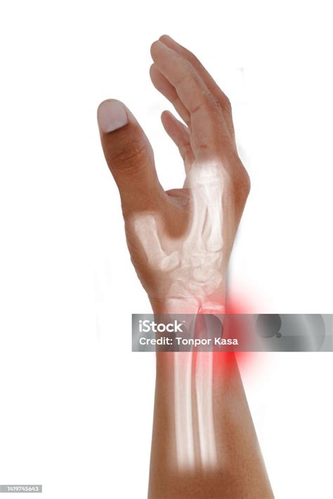 Photo Libre De Droit De Radiographie De La Main Et Du Poignet Vue Oblique Fracture Ulna Distale