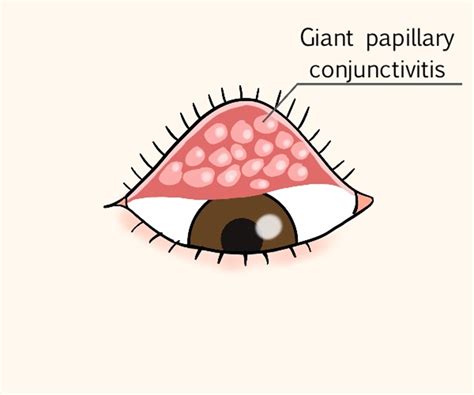 Allergic Conjunctivitis Hoya Corporation