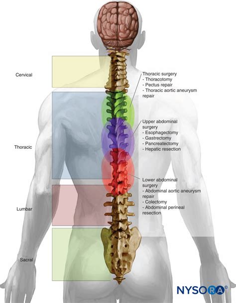 Epidural Catheter Level At Abby Pomeroy Blog