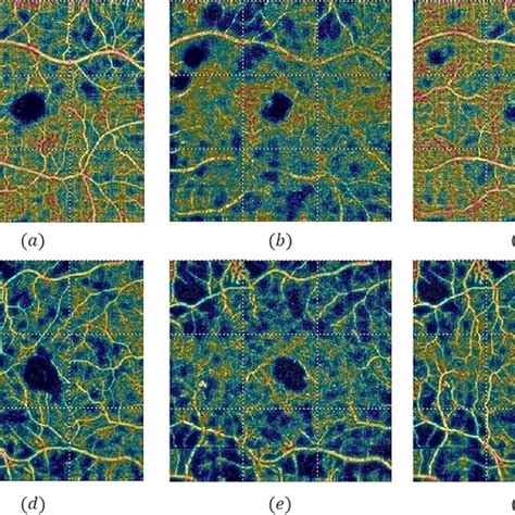 Vascular Density Maps Of Two Patients In Npdr And Pdr Groups Top Row