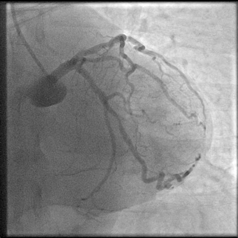 Stenosis Instance Seg Instance Segmentation Dataset And Pre Trained Model By