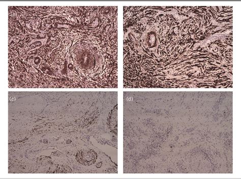 Figure 1 From Angioleiomyoma Of The Inferior Turbinate A Rare Cause Of