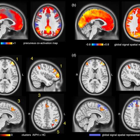 Resting‐state Network Connectivity In Inph Patients And Healthy