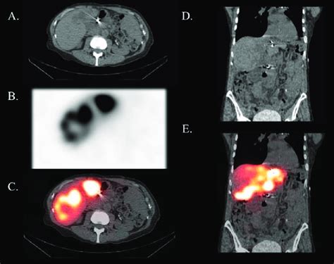 This Figure Represents A Post Treatment Spect Ct Image For A