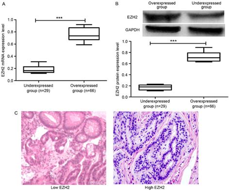 ezh2 expression status in patients with crc a ezh2 mrna expression