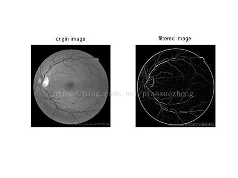 眼底图像血管增强与分割 （1）匹配滤波算法原理及实现 Csdn博客