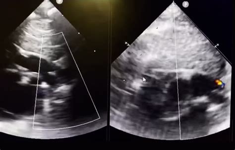 Andrei Satsuk Auf Linkedin Echo Echocardiography Pda Study Learn Heart Ultrasound Andrei Satsuk Auf Linkedin Echo Echocardiography Pda Study Learn Heart Ultrasound