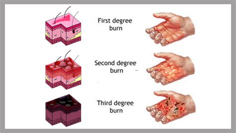 Texas Personal Injury Claims First Degree Burns