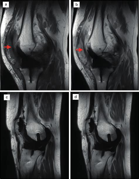 Quantification Of Intra Articular Fibrosis In Patients With Stiff Knee