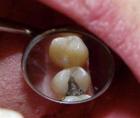 Filling Between Teeth Online