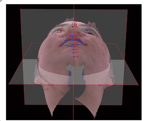 Differences In Soft Tissue Malar Height Between The Fractured And