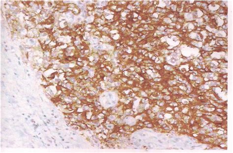 Note The Positivity Of Tumor Cells To Markers Cd31 In Download