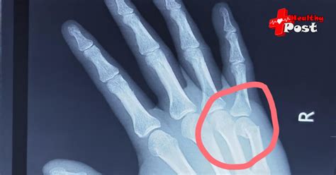 Metacarpal Fracture Postoperative Rehabilitation Recovery Tips