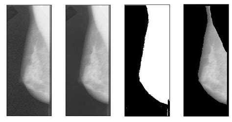 a original mammogram b image after downsampling and median