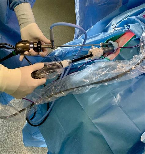 Representative Photo Showing The Single Incision Laparoscopic Surgery