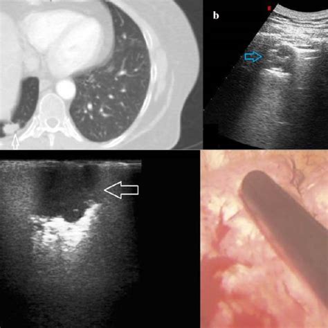 A Axial Computed Tomography Ct Scan Showing A Pulmonary Nodule Download Scientific Diagram