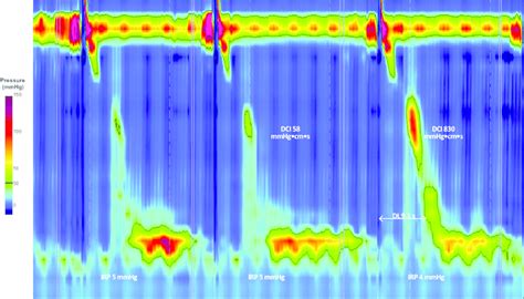 Diffuse Esophageal Spasm Manometry