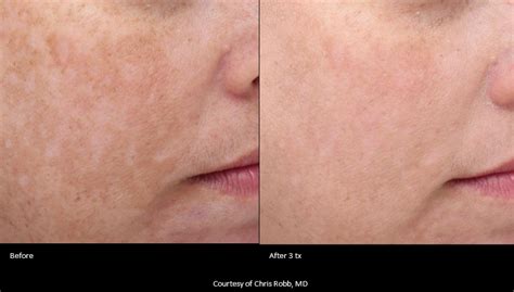 BBL HERO MOXI MedSpa