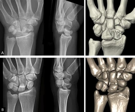 X Rays And Corresponding Ct Scans Of A Trans Scaphoidal Perilunate