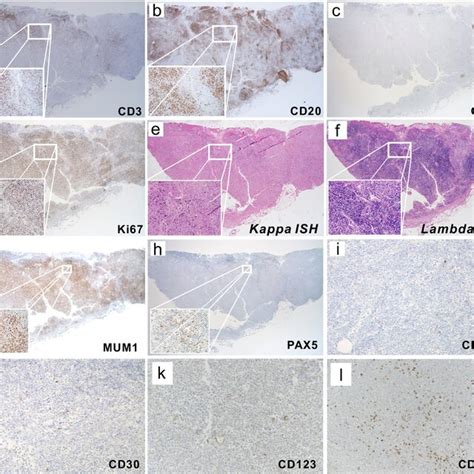 Florid Lambda Monotypic B Cell Proliferation In Fatal Severe Fever With