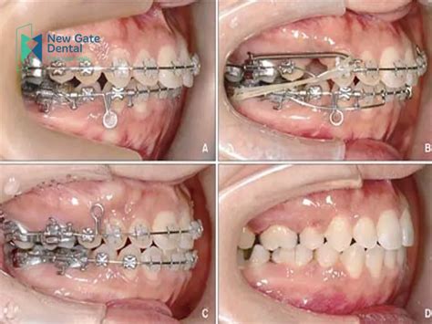 How Much Does Overbite Braces Cost And Braces Duration