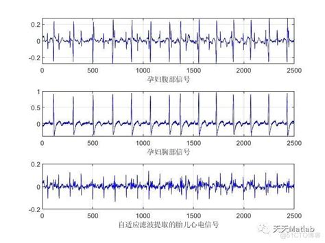 【心电信号ecg】基于nlms算法实现孕妇胎儿心电信号提取附matlab代码 csdn博客