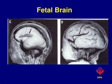 Ppt Voxel Averaging Voxel Based Morphometry Vbm Normals Powerpoint Presentation Id6323209