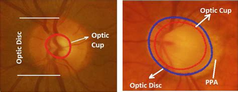 Peripapillary Atrophy In Glaucoma