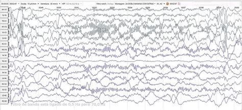 Patient 6 Generalized Paroxysmal Fast Activity Traditionally Linked To