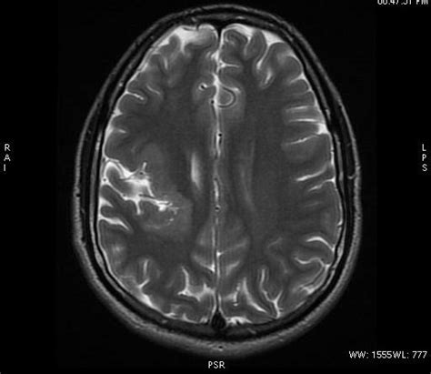 Right Perisylvian Syndrome Eurorad