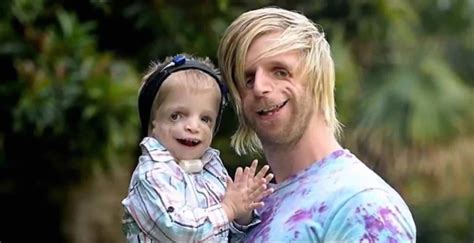 Maravilha Da Sindrome De Treacher Collins Treacher Collins Syndrome