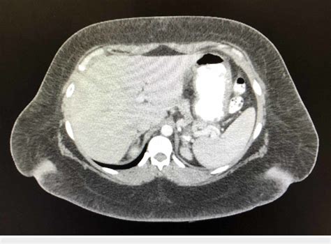 Axial Preoperative Ct Scan Was Unremarkable Download Scientific Diagram