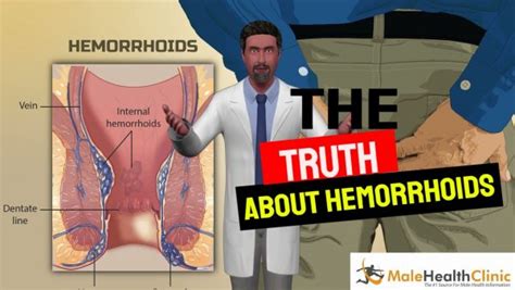 The Truth About Hemorrhoids Male Health Clinic