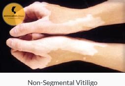White Patches Vitiligo Treatment In Delhi Melanocyte Transplant Dr