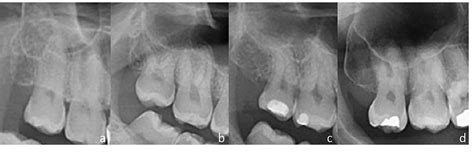 Figure 1 From Panoramic Radiography Vs Cbct In The Evaluation Of The Maxillary Third Molar