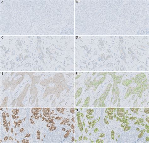 Applications Of Artificial Intelligence In Breast Pathology Archives