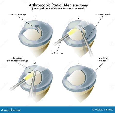 Arthroscopic Partial Meniscectomy Stock Vector Illustration Of