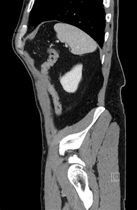 Closed Loop Small Bowel Obstruction Internal Hernia Radiopaedia