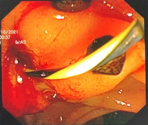 Drnandan Ashok On Linkedin Case Cbd Stones With Cholangitis