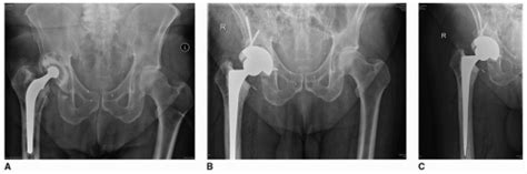 Cemented Acetabular Component In Total Hip Arthroplasty