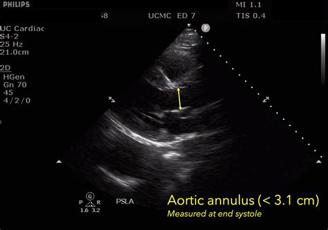 Pocus For The Win Aortic Dissection Emra