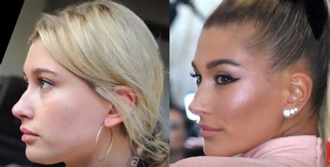 Did Hailey Baldwin Have Plastic Surgery