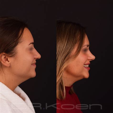 закрытая септо-ринопластика - Dr.Koen